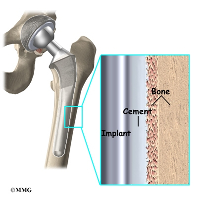 Prothèse – Chantiers de Sciences